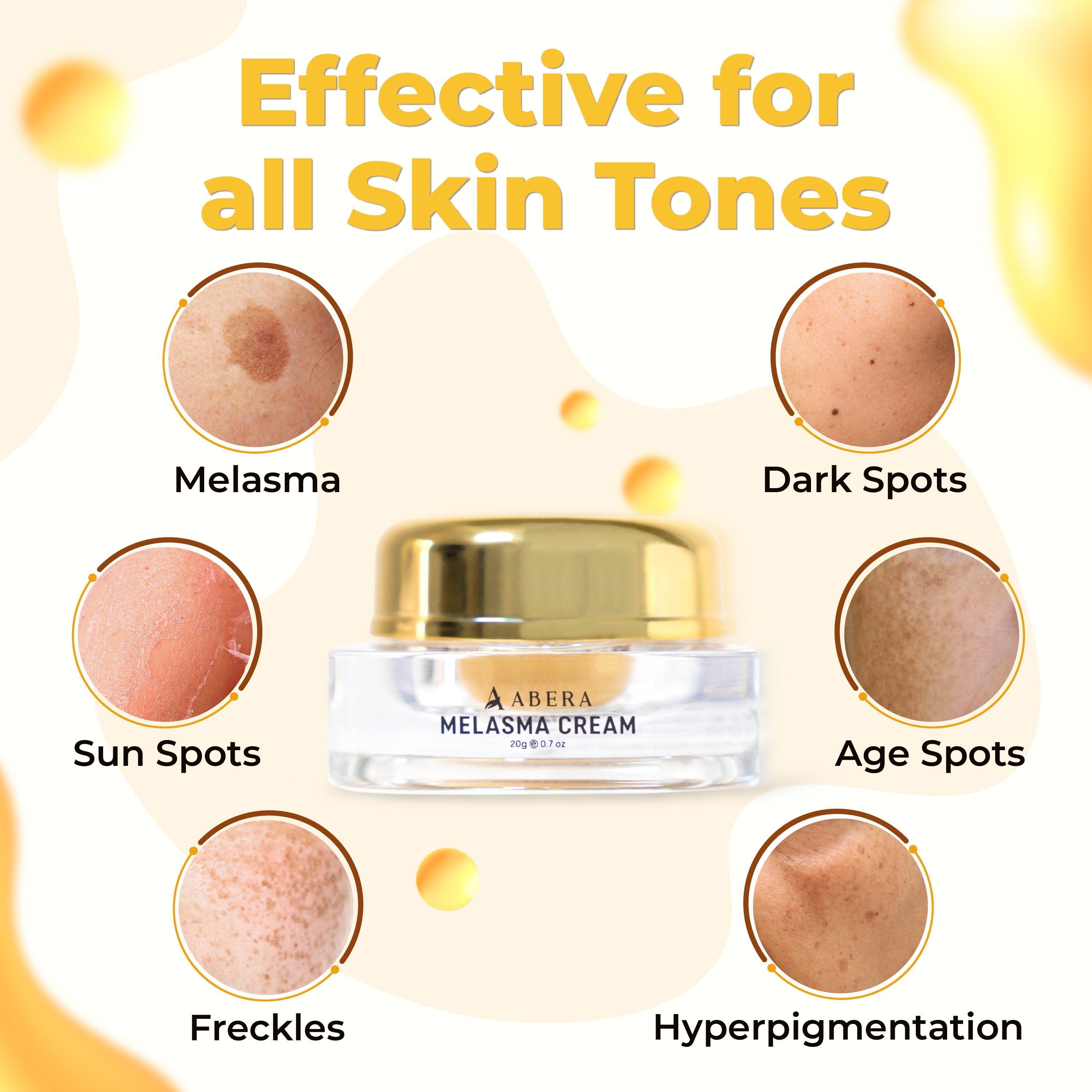 ABERA MELASMA CREAM 20G – HELPS FADE MELASMA, FRECKLES, AGE SPOTS, SMO ...